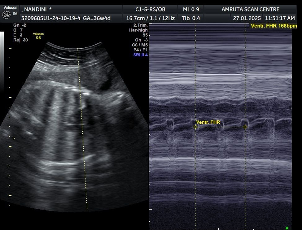 Important Check Scans: AFI, FHR, Cervical Status & Doppler